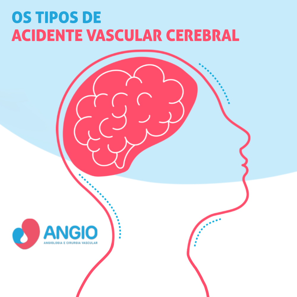 OS TIPOS DE ACIDENTE VASCULAR CEREBRAL | Angio - Angiologia e Cirurgia Vascular